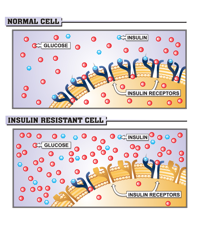 How Insulin Resistance Leads to Type 2 Diabetes | Reversing T2D